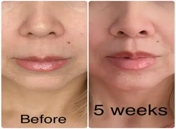 Lip Lifts | Honolulu Lip Surgery - Hawaii Facial Plastic Surgery